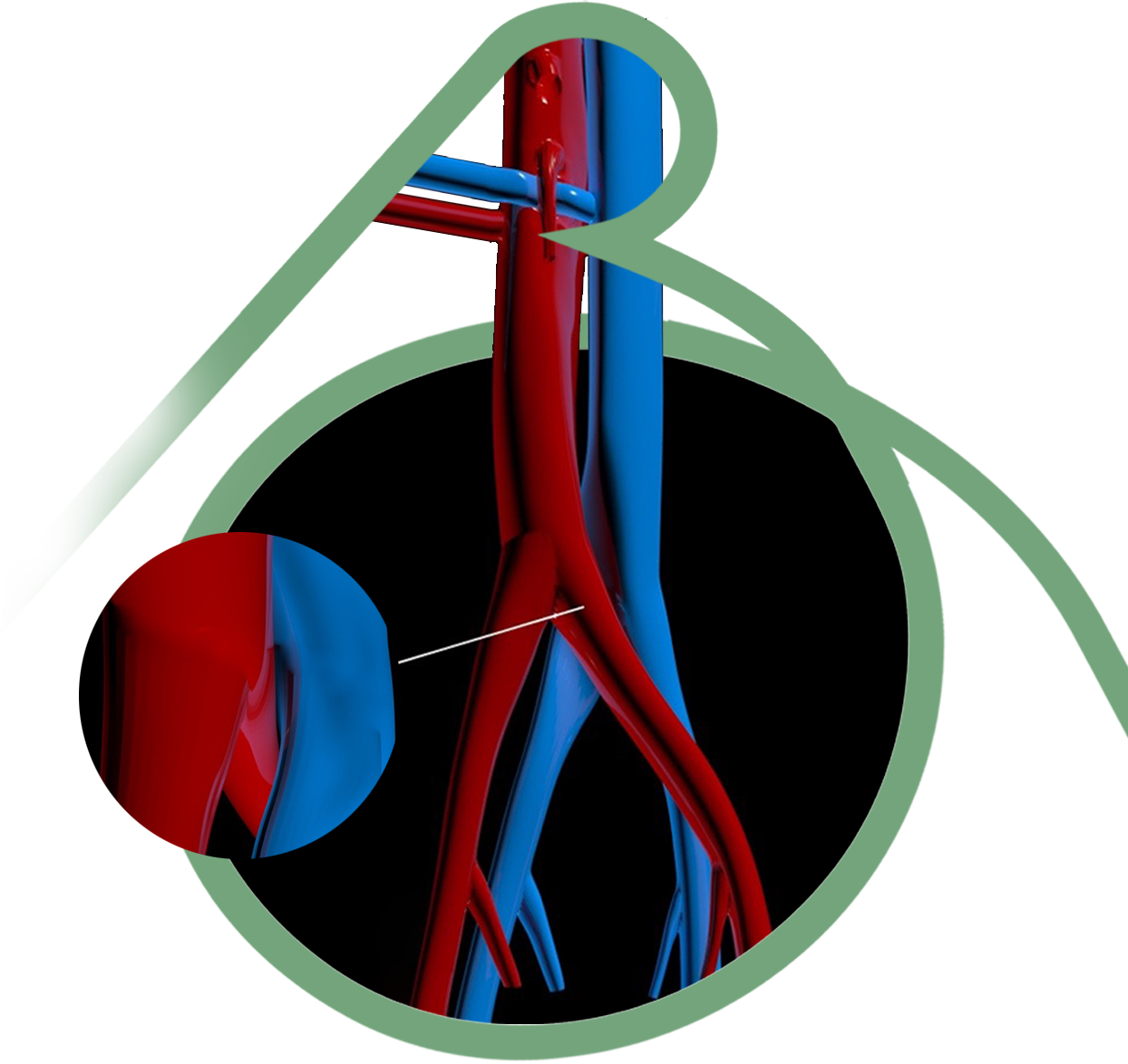 Síndrome de Cockett – Bellos Laser
