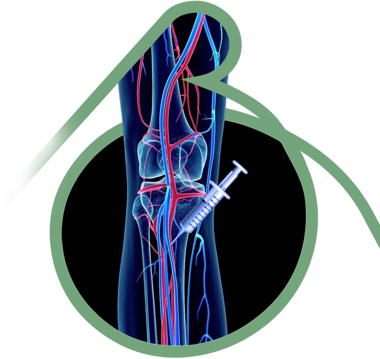 Varizes com Espuma Densa – Bellos Laser Vascular