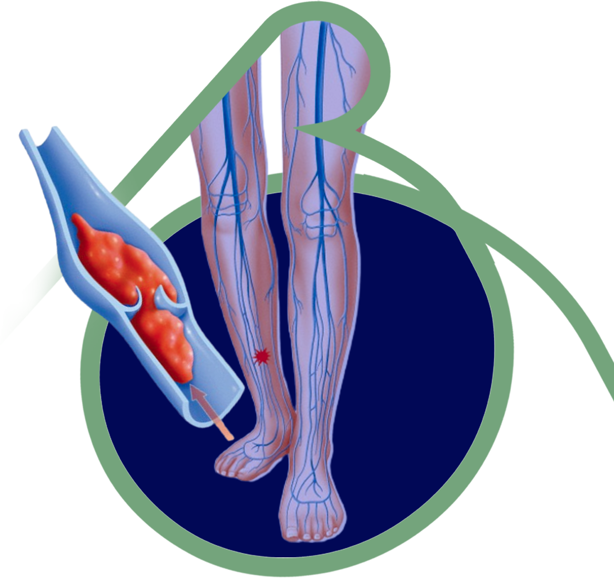 Trombose Venosa Profunda – Bellos Laser